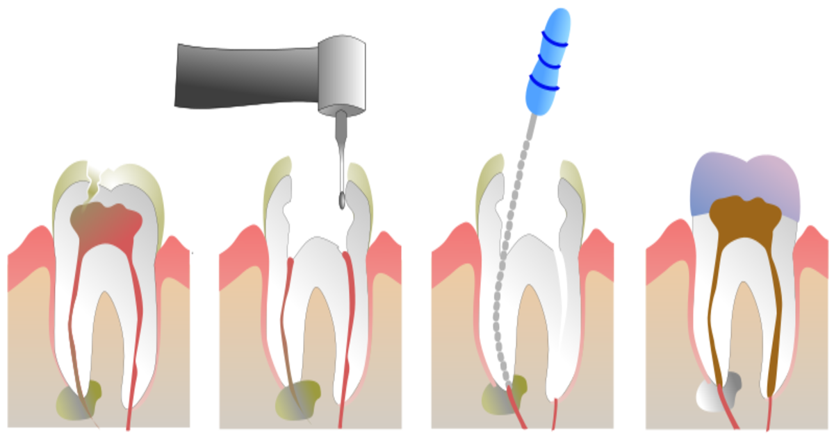 Endodontia - Conheça Todos os Detalhes da Especialidade Aqui