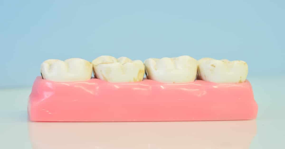 Hiperdontia Tem Diversas Causas e Pode Ser Tratada