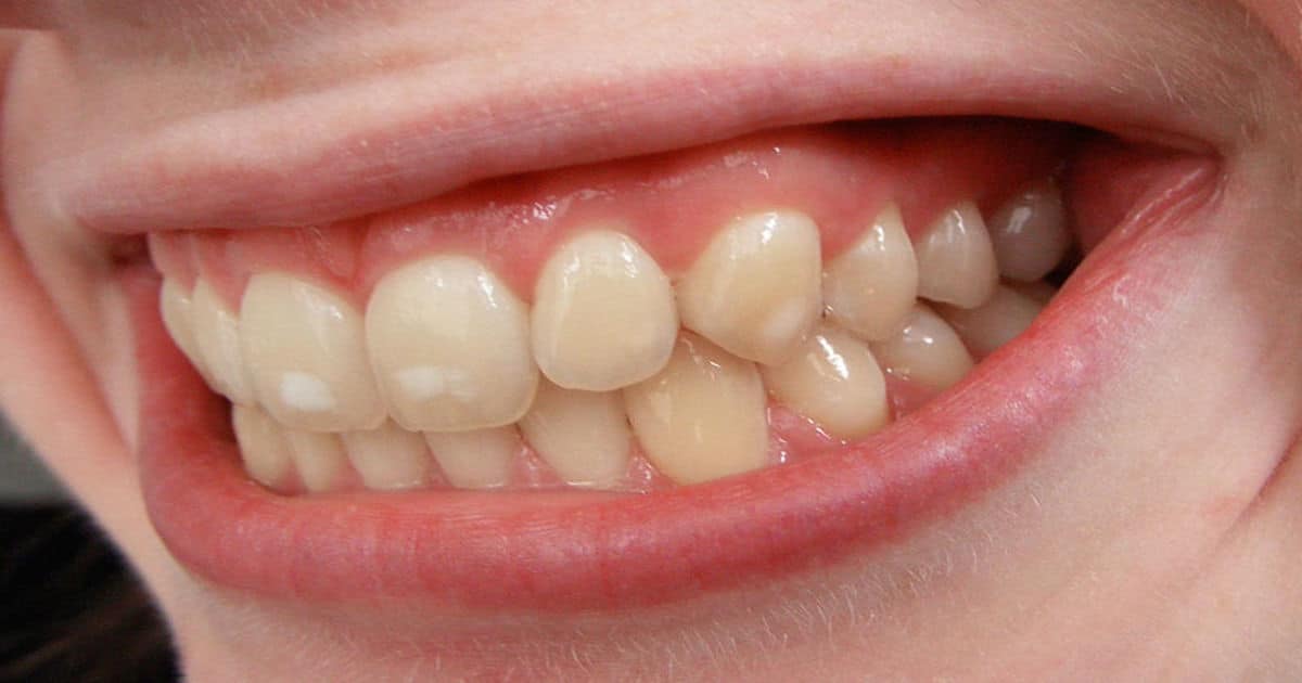 Cor dos Dentes - Qual é a Ideal e Como Evitar o Escurecimento?
