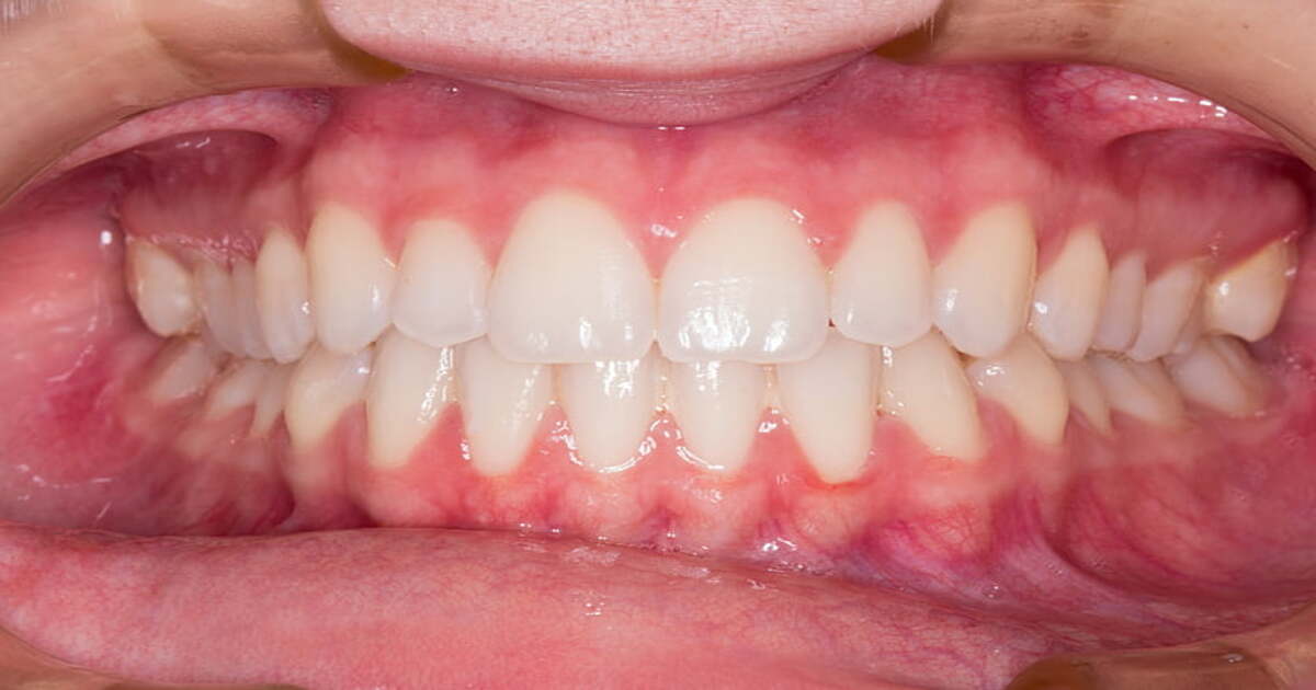 Periodontia - Mais Sobre a Especialidade e Doenças Comuns