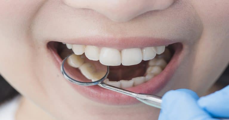 O que é Dente Preto? Entenda as Causas e Tratamentos